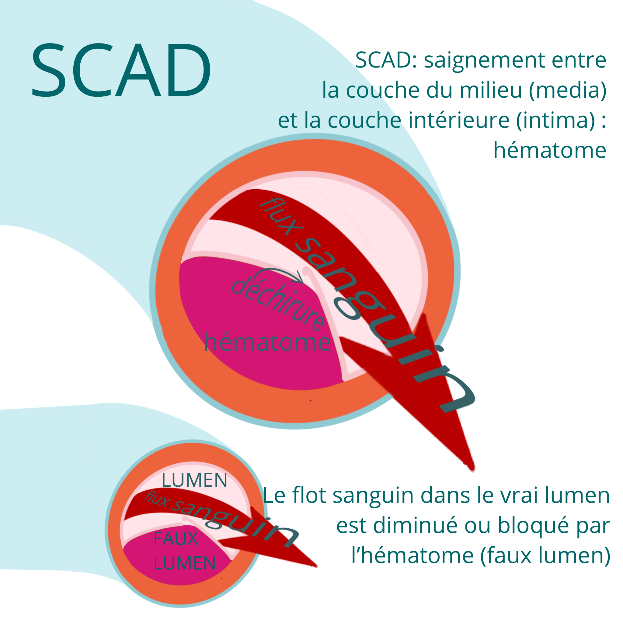 Comprendre la SCAD - SCAD info